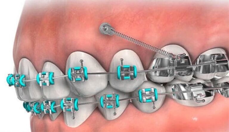 Braces & Implants - Smile Care Dental Hospital